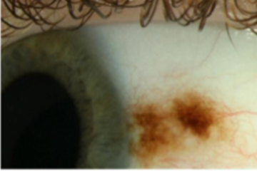 Pigmented and non-pigmented lesions - Moorfields Eye Hospital