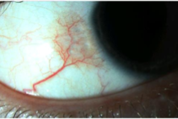 Pigmented and non-pigmented lesions - Moorfields Eye Hospital